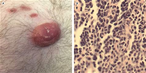 Sister Mary Joseph Nodule In Mantle Cell Lymphoma The Lancet Oncology