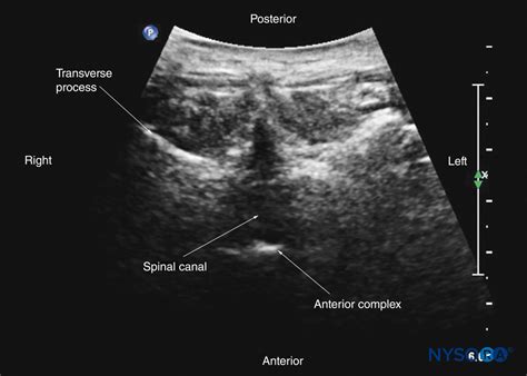 Spinal Sonography And Applications Of Ultrasound For Central Neuraxial