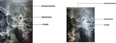 Figure 1 From Reduction Of Manually Irreducible Tmj Dislocation With