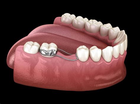What Does A Spacer Do For Teeth Dentprime