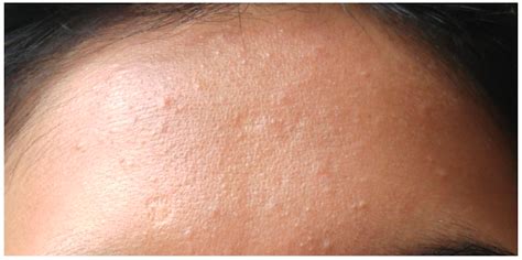 Whiteheads On Forehead Wont Go Away