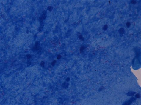 Acid Fast Bacillus Mycobacterium Tuberculosis Grading 3 Dr Protick Kumar Mondal
