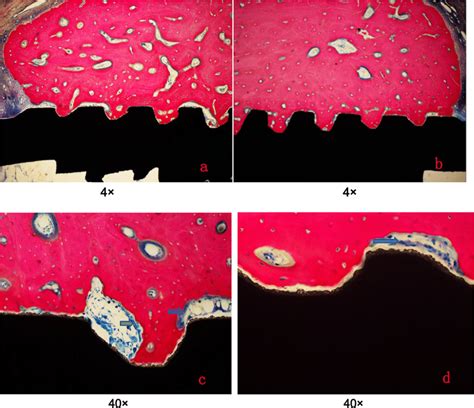 Histology Sections Of Implant And Bone Tissue In Methylene Blue−fuchsin