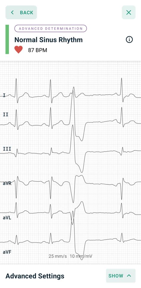 Is This An Ectopic Beat Rpvcs