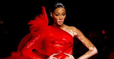 Día Mundial Del Vitiligo La Inspiradora Historia De La Modelo Que Es Un Emblema De Resiliencia