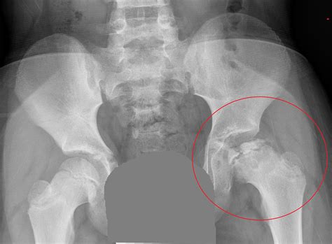 Perthes Disease X Ray Features