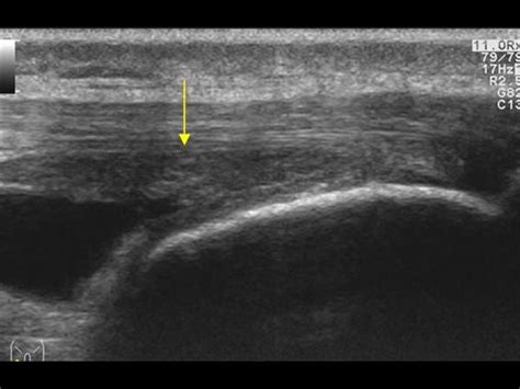 Musculoskeletal Joints And Tendons 66 Knee Case 665 Distal Patellar Tendon Insertion