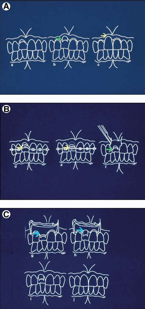 A Crown Lengthening With Surgery Only Note The Inconsistent Gingival