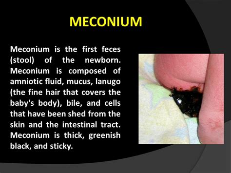 Meconium Aspiration Syndrome Ppt Video Online Download