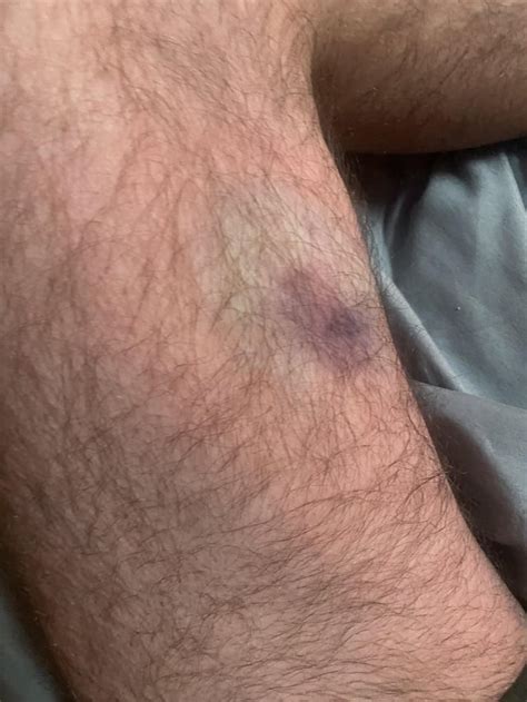 Initial Recluse Spider Bite