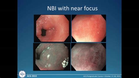 Advanced Endoscopic Techniques In Evaluation Of The Esophagus Where Do