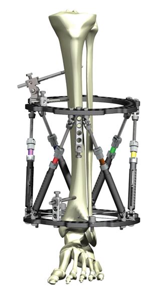 Tsf Taylor Spatial Frame Mediplat