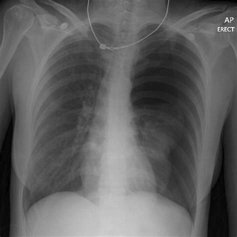 Tension Pneumothorax Tracheal Deviation