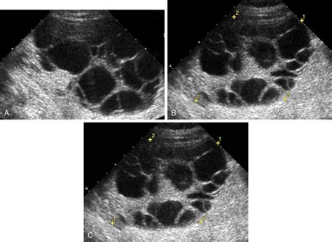 Theca Lutein Cyst Ultrasound