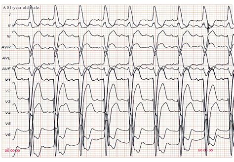 Topic Incomplete Left Bundle Branch Block 12 Lead Ecg Certification