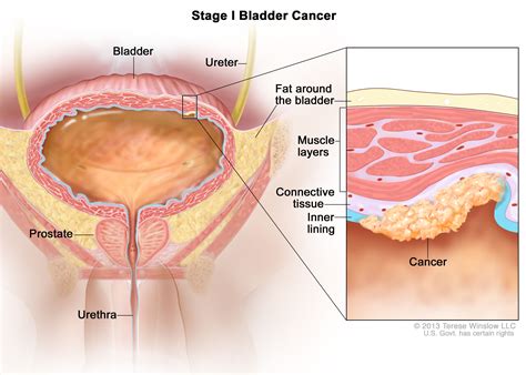 Bladder Cancer Stages Nci