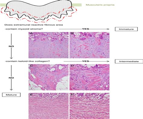 Desmoplastic Pattern At The Tumor Front Defines Poor Prognos The American Journal Of