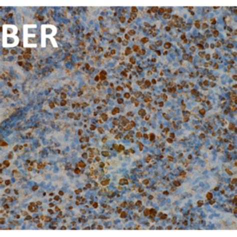 Dlbcl Monomorphic B Cell Ptld Dlbcl Showing Diffuse Infiltration Of