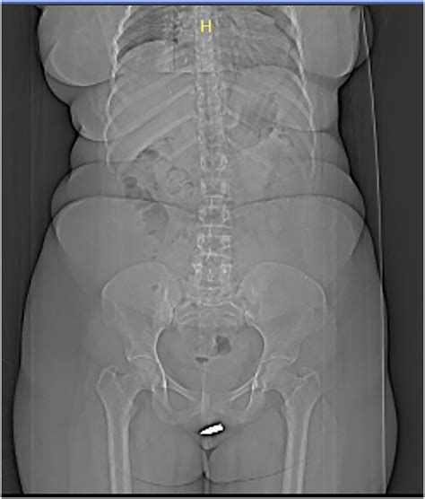 Woman Has Bullet Removed From Clitoris In ‘first Injury Of Its Kind