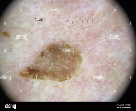 Dermatoscope Image Of A Seborrheic Keratosis On The Back Of A 68 Year Old White Male Patient