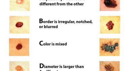 “so I Have This Mole… How To Identify Skin Cancer And How To Prevent