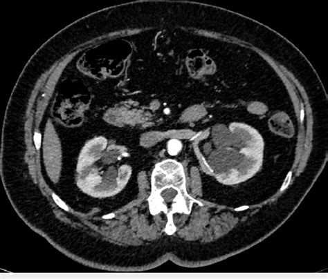 Axial Cross Section Of An Abdominal Enhanced Computed Tomography Ct