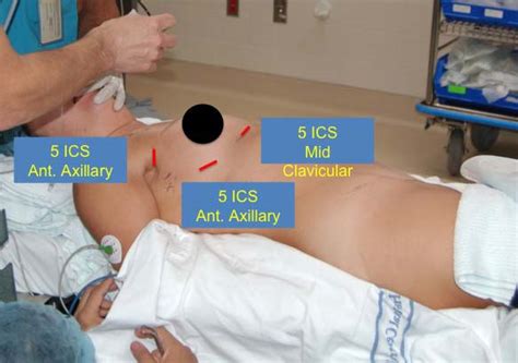 Robotic Thymectomy Via Right Chest Approach Ctsnet