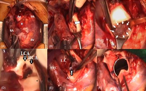 Intraoperative Surgical Pictures Showing Aortic Root Abscess A And Download Scientific