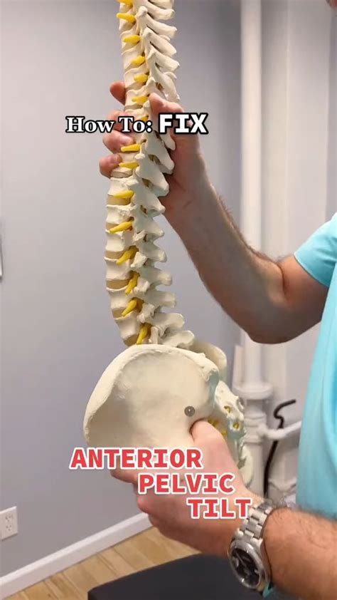Easy Anterior Pelvic Tilt Correction You Should Try Artofit