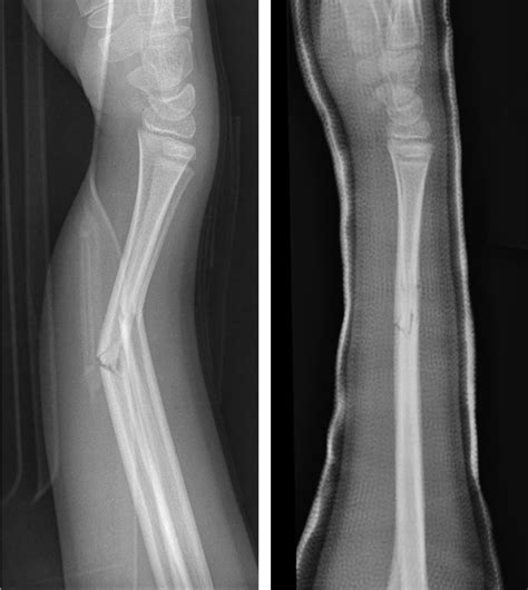 Human Broken Arm X Ray