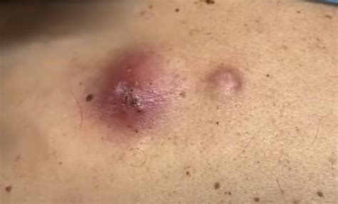 Infected Cysts Incision And Drainage New Pimple Popping Videos