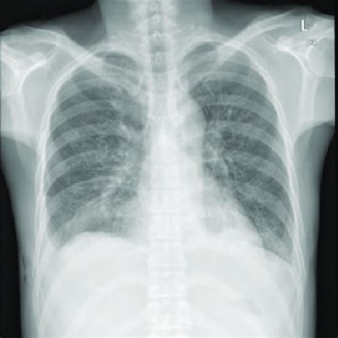 Cxr With Diffuse Miliary Pattern Download Scientific Diagram
