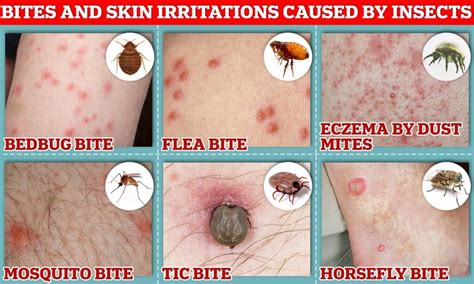 Ways To Identify And Treat Bed Bug Bites