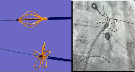 What Is Catheter Ablation For Atrial Fibrillation Af Asian Heart And Vascular Center