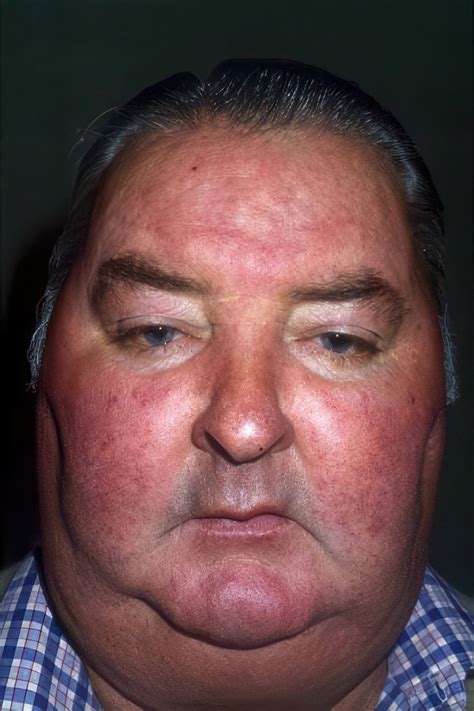 Got Moon Face Tips On Causes And Fixes