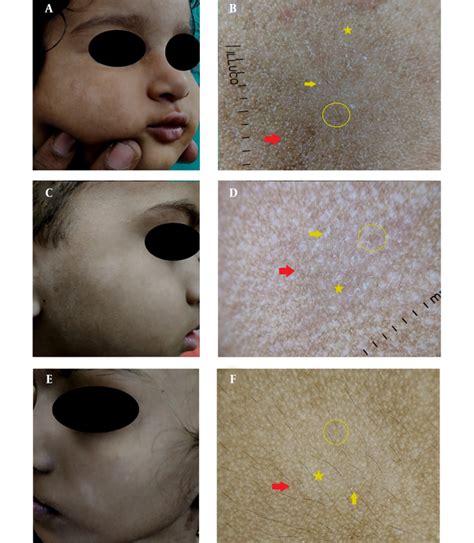 Pityriasis Alba Vs Vitiligo
