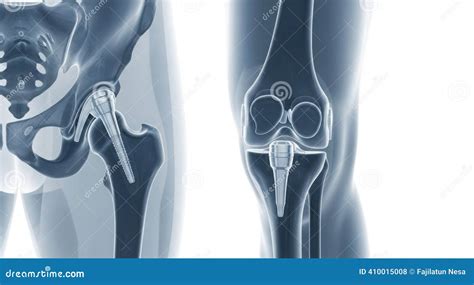 Implants Knee Of Metal And Plastic The Knee Prosthesis Replaces The