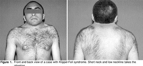Is Klippel Feil Syndrome A Disability