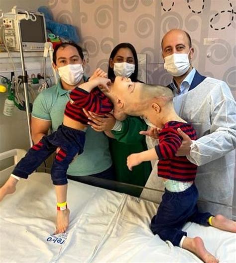 3 Year Old Conjoined Twins With Fused Brains Separated In Historic