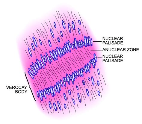 Basal Cell Carcinoma Histology Palisading