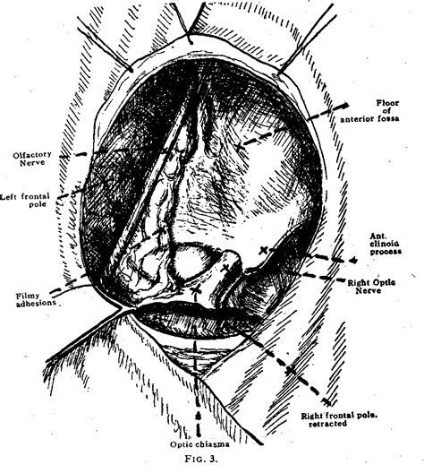 Figure 3 From Indirect Injury Of The Optic Chiasma A Case Report