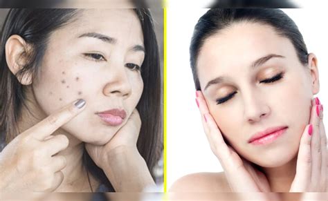 पिंपल्स चले गए लेकिन रह गए दाग धब्बे अपनाएं ये 5 सरल घरेलू उपाय