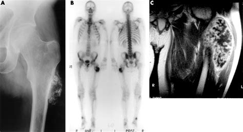 Intermediate Grade Osteosarcoma And Chondrosarcoma Arising In An Osteochondroma A Case Report