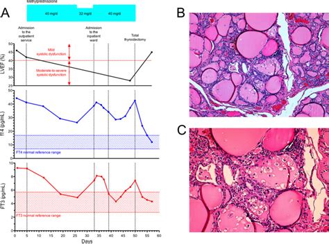 Salvage Total Thyroidectomy For Amiodarone Induced Thyrotoxicosis In A