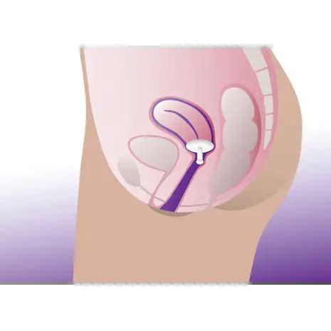 Gellhorn Vaginal Pessary Long Stem Profem
