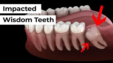 What Is A Impacted Tooth