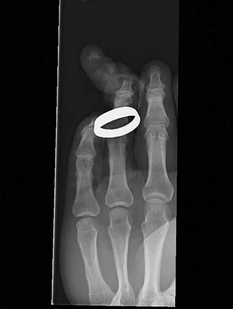 Anterior Posterior Radiograph Of Ring Avulsion Revealing A Distal Tuft