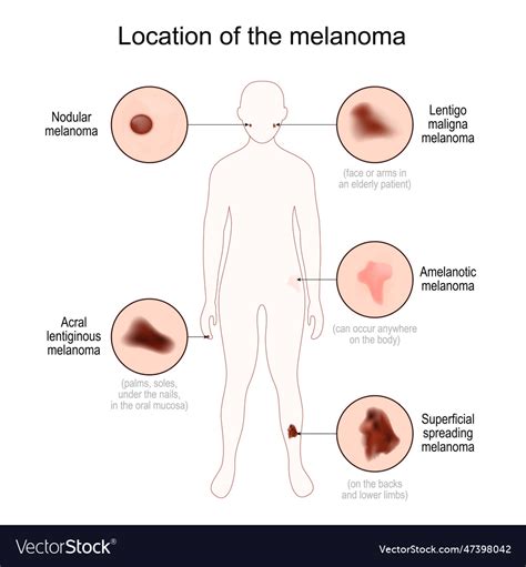 Melanoma