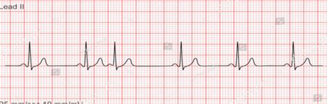 Cardiac Rhythms Flashcards Quizlet
