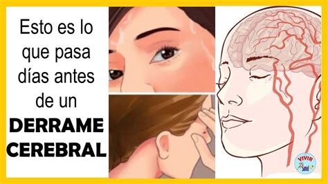¿cómo Prevenir Un Derrame Cerebral En Tus Hábitos Diarios Imperio